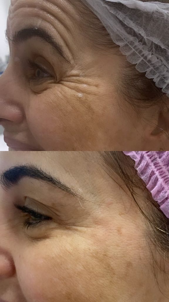 Toxina Botulínica - ELEVAESTHETIC: Clínica de Estética Facial, Corporal ...
